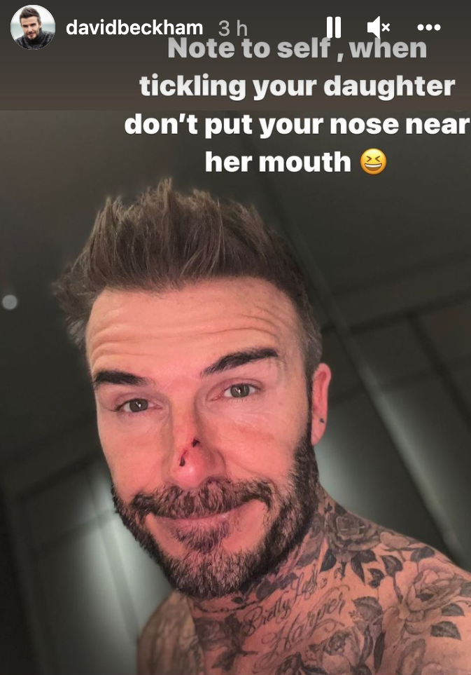 David Beckham shows off nasty injury inflicted by daughter Harper