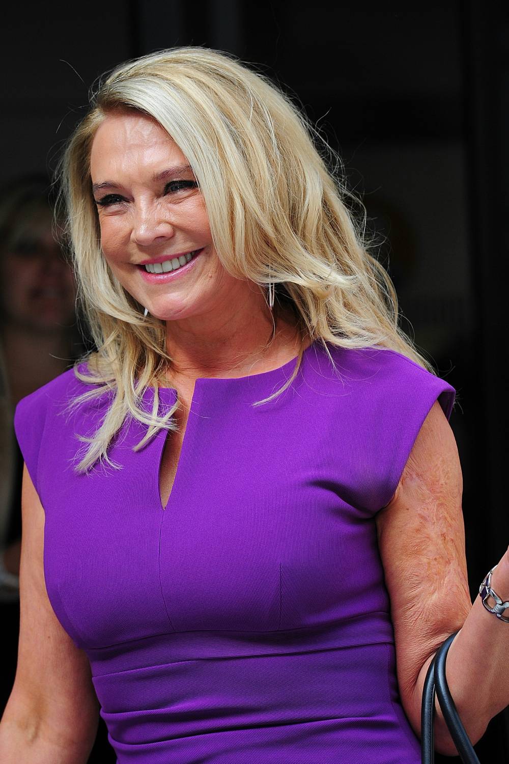 Amanda Redman's brave journey with burns scars from childhood accident