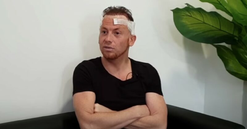 Joe Swash's insecurity battle that led to multiple hair transplants